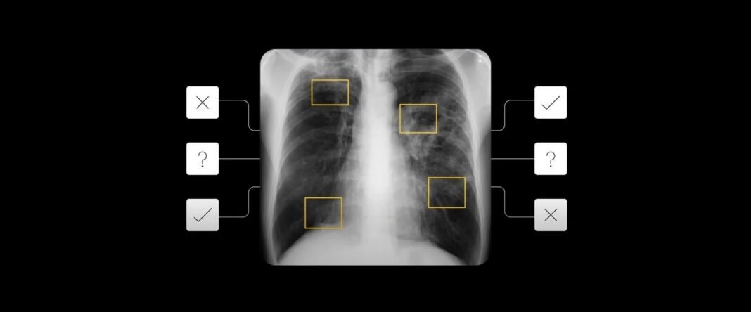 AI Tools In Tuberculosis Screening: Bridging The Gap Between Innovation ...